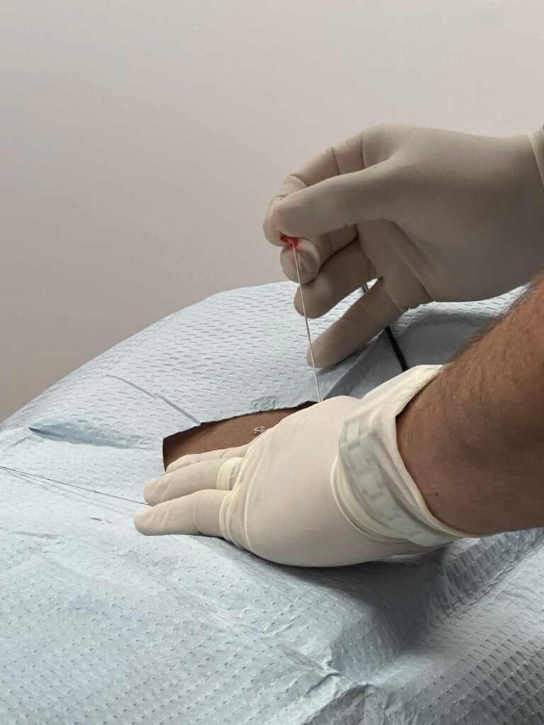 Sacroiliac Joint Injection (Steroid, PRP, Hyaluronic Acid) - cdlrehab.com